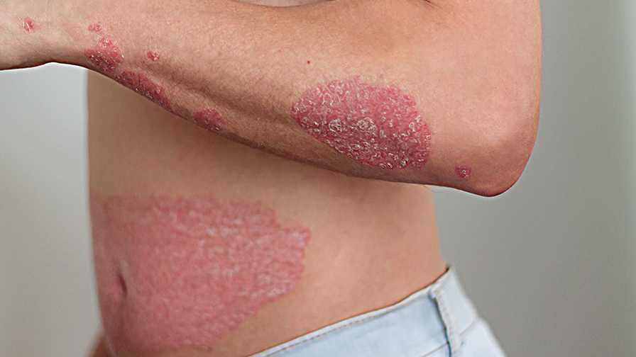 Psoriasis pustuleux sévère : Identification d’une voie thérapeutique ...